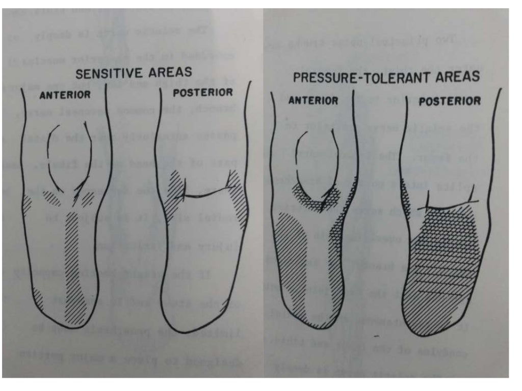 Patellar Tendon Bearing Prosthesis