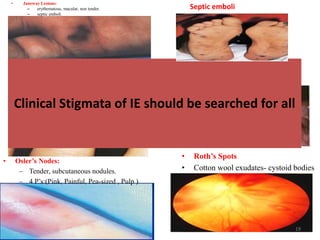 Infective Endocarditis- Prevention and Management | PPTX