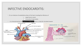 Infective endocarditis/ endocarditis | PPTX