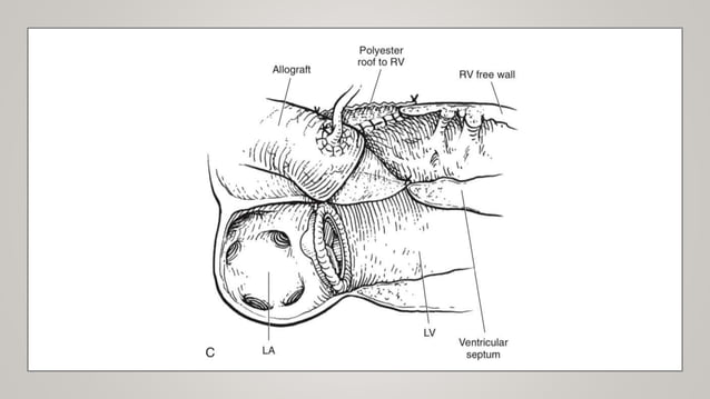 Infective Endocarditis- surgical indication & principle of surgery | PPT