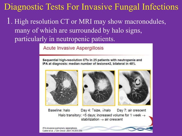 Invasive Fungal Infections: Overview, Diagnosis & Treatment Approaches ...