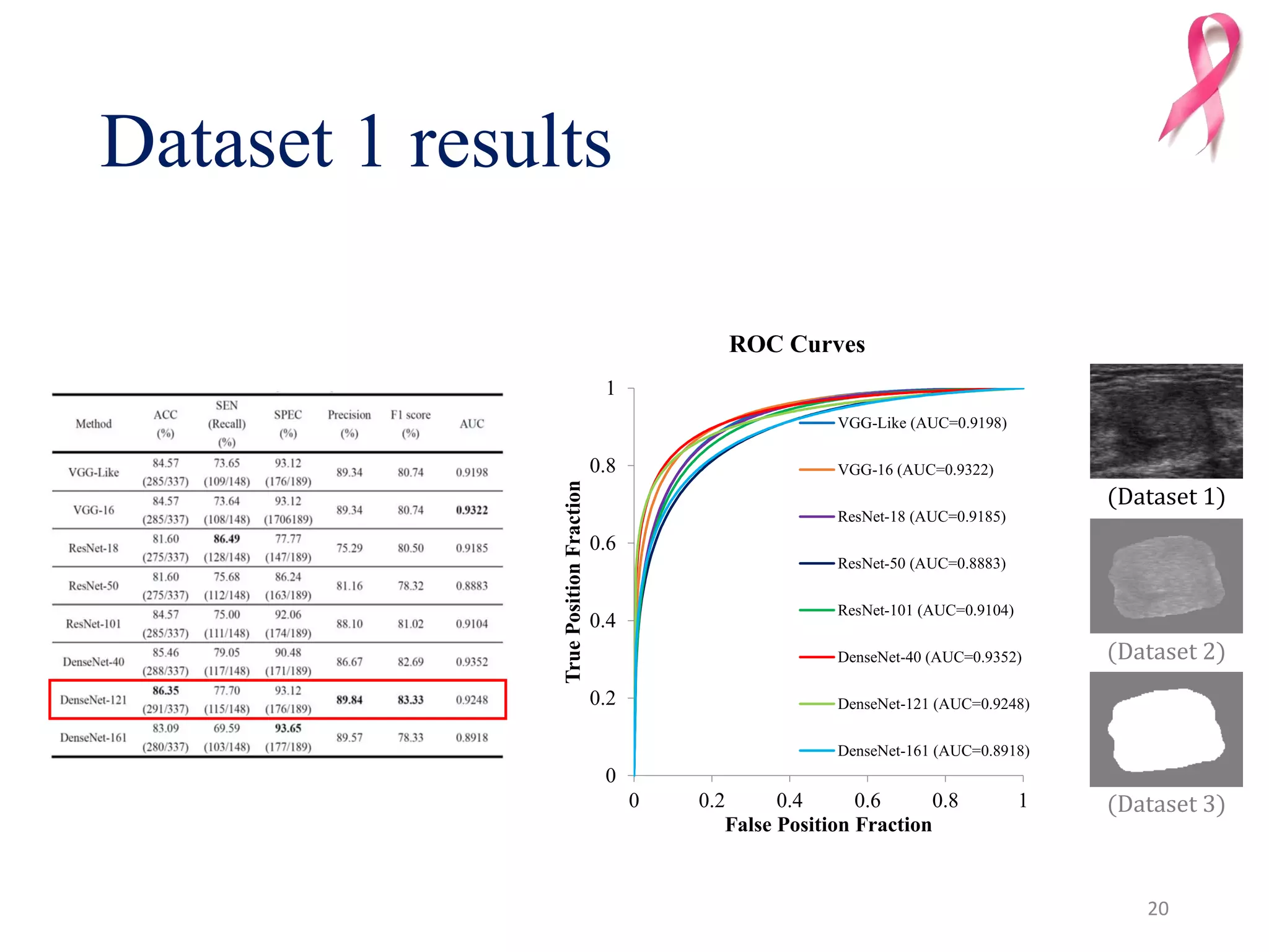 Computer‐Aided Diagnosis of Breast Cancer Using Ensemble Convolutional Neural Networks ...