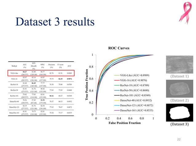Computer‐Aided Diagnosis of Breast Cancer Using Ensemble Convolutional Neural Networks ...