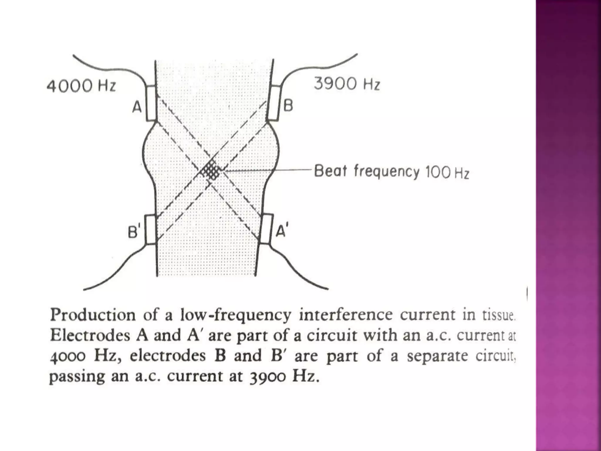 Interferential Therapy (IFT) | PPTX