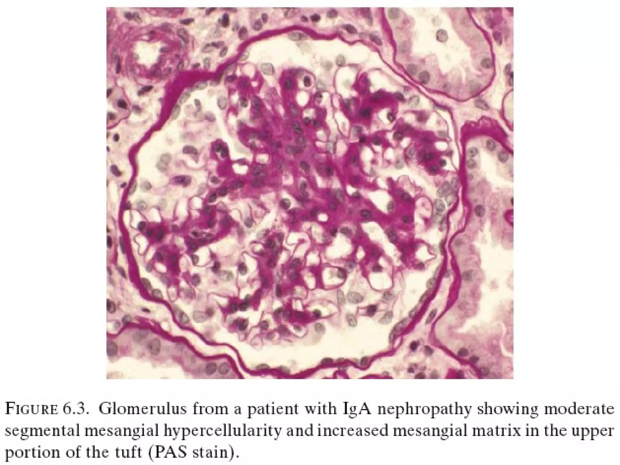 IgA nephropathy | PPT