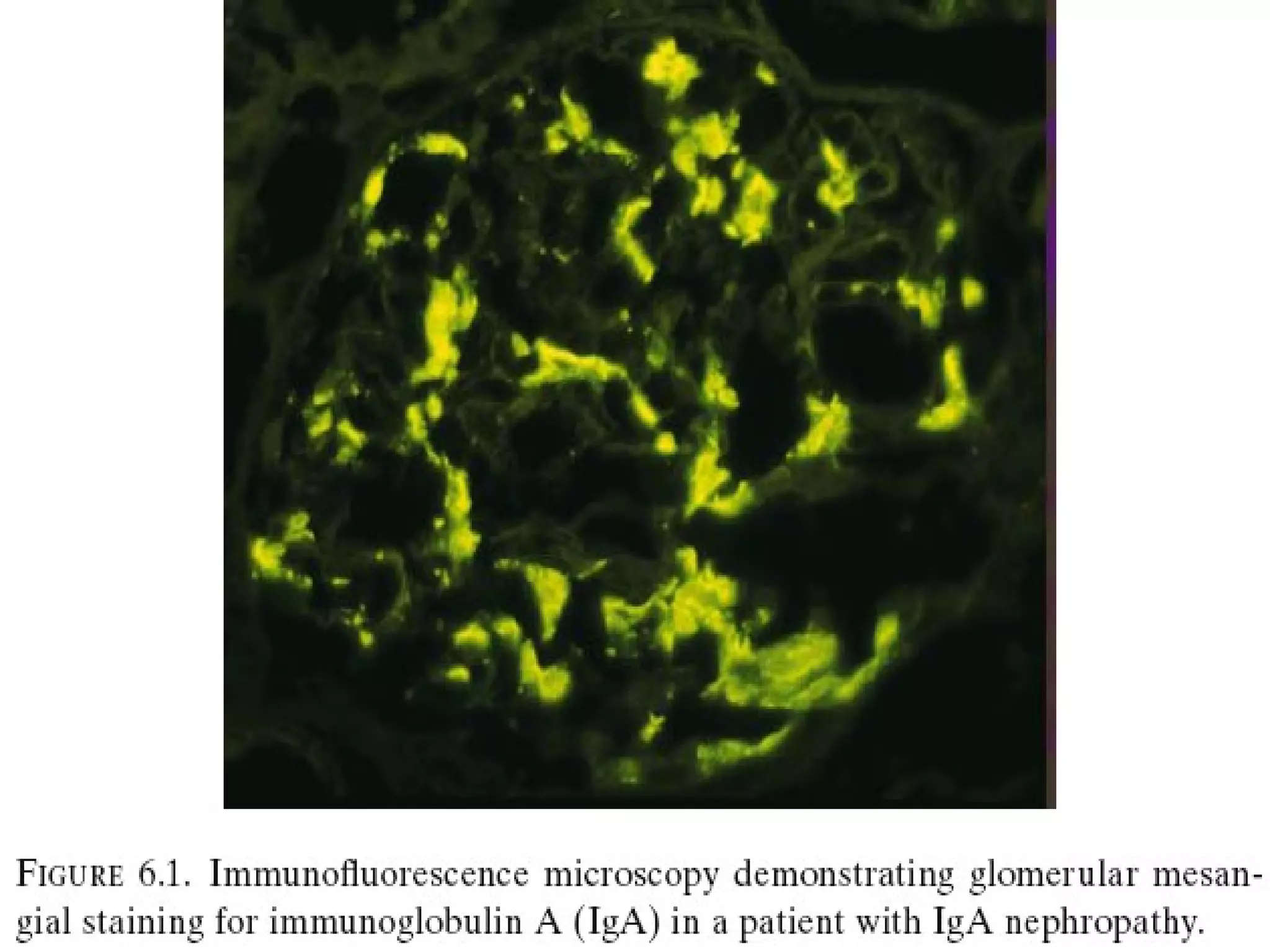 IgA nephropathy | PPT