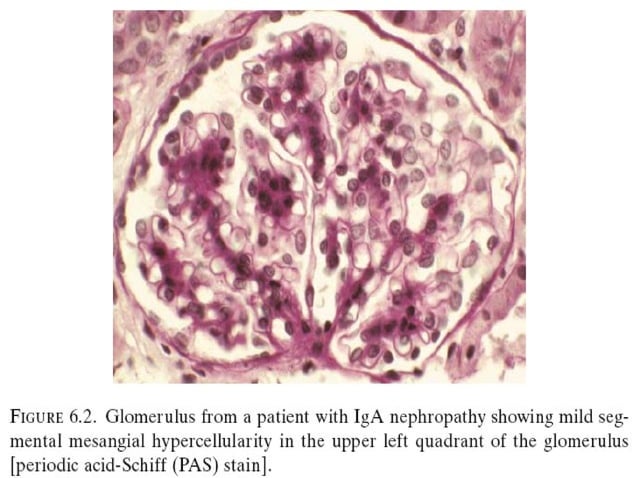 IgA nephropathy | PPT