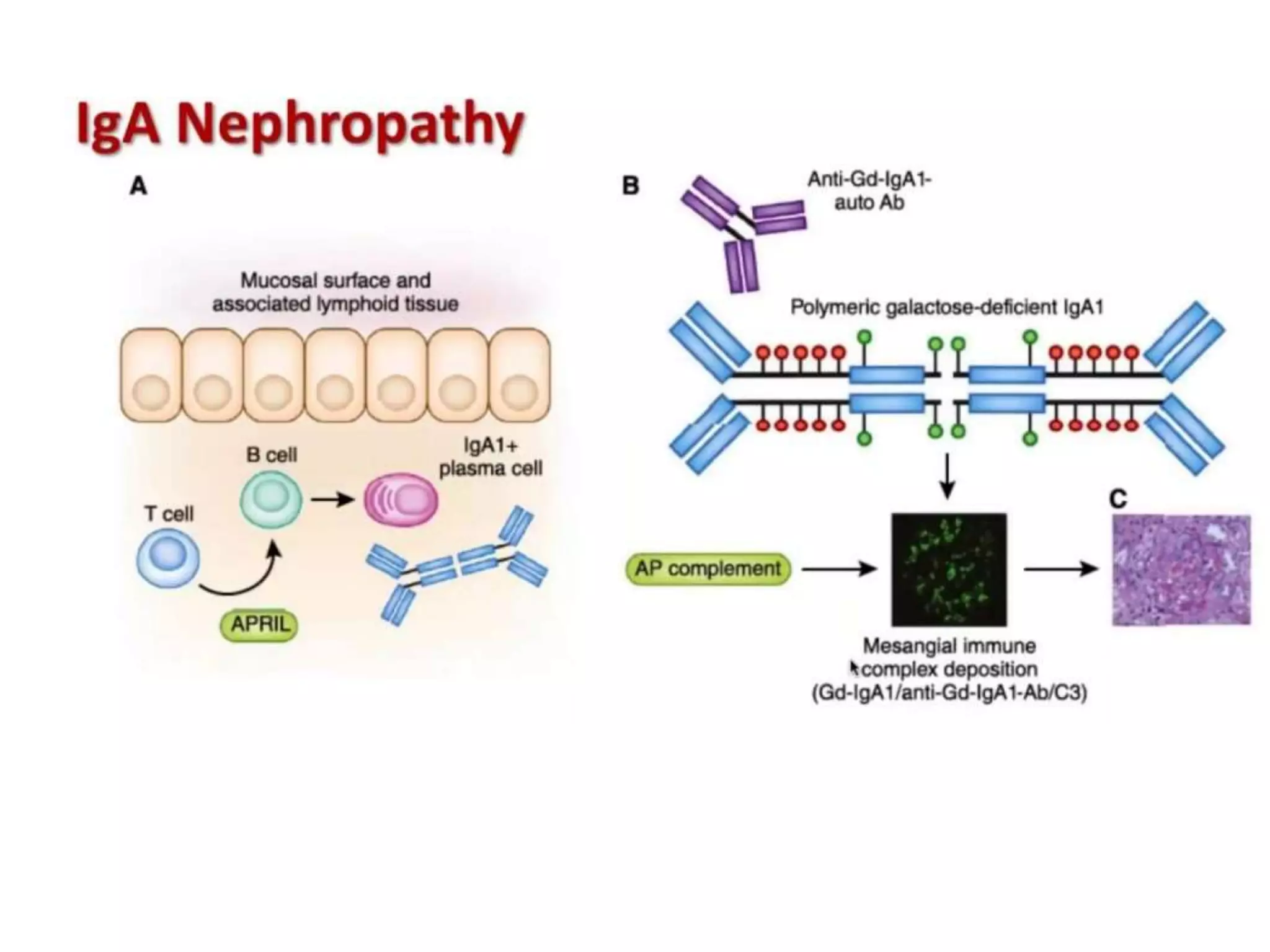 Ig A nephropathy | PPTX
