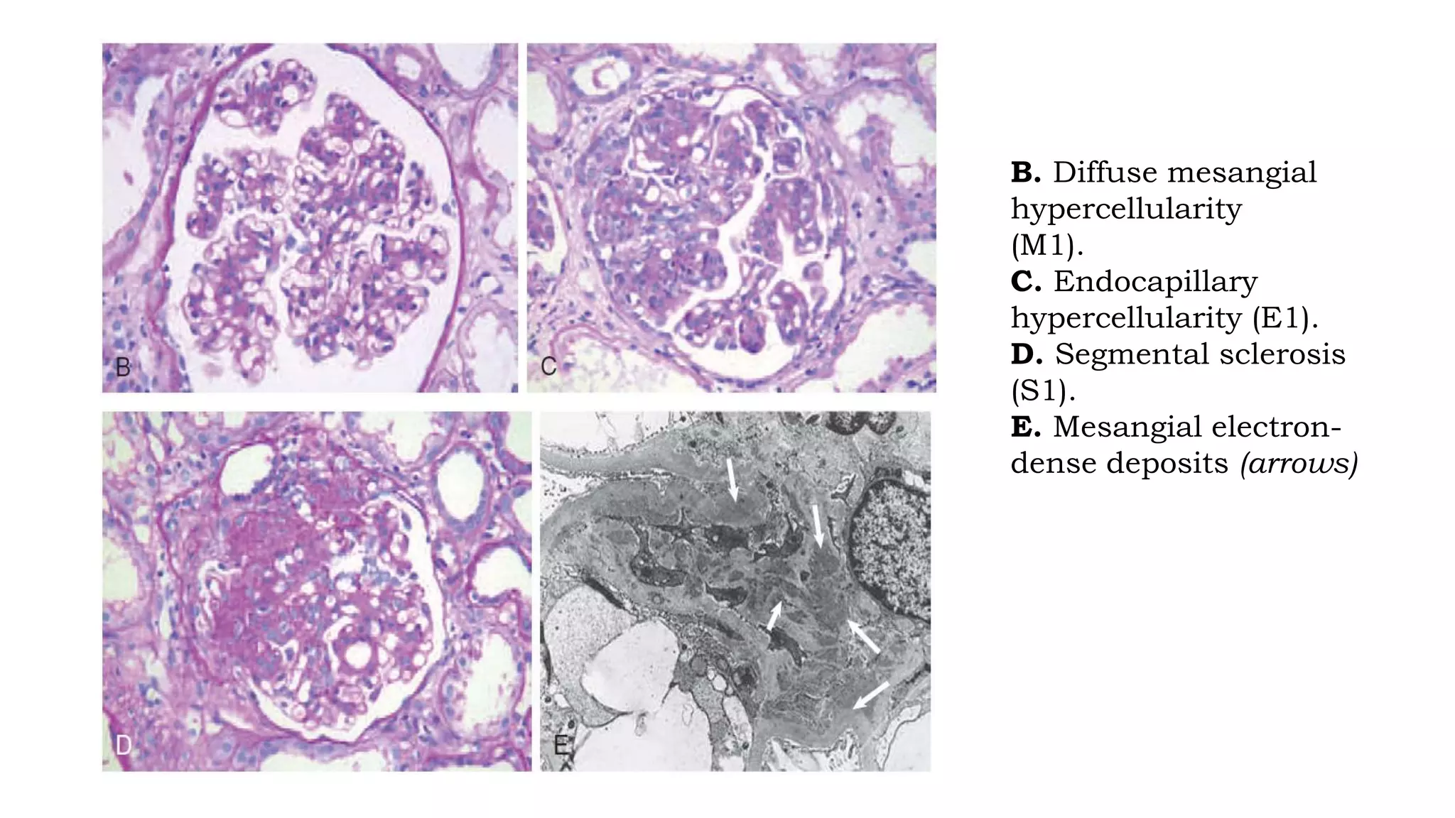 IgA nephropathy | PPTX