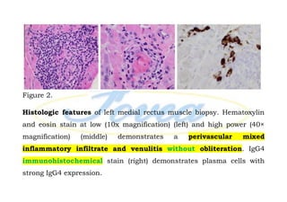 Ig G4-related ophthalmic disease | PPT