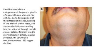 IgG4-Related Disease | PDF