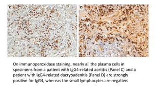 IgG4-Related Disease | PDF