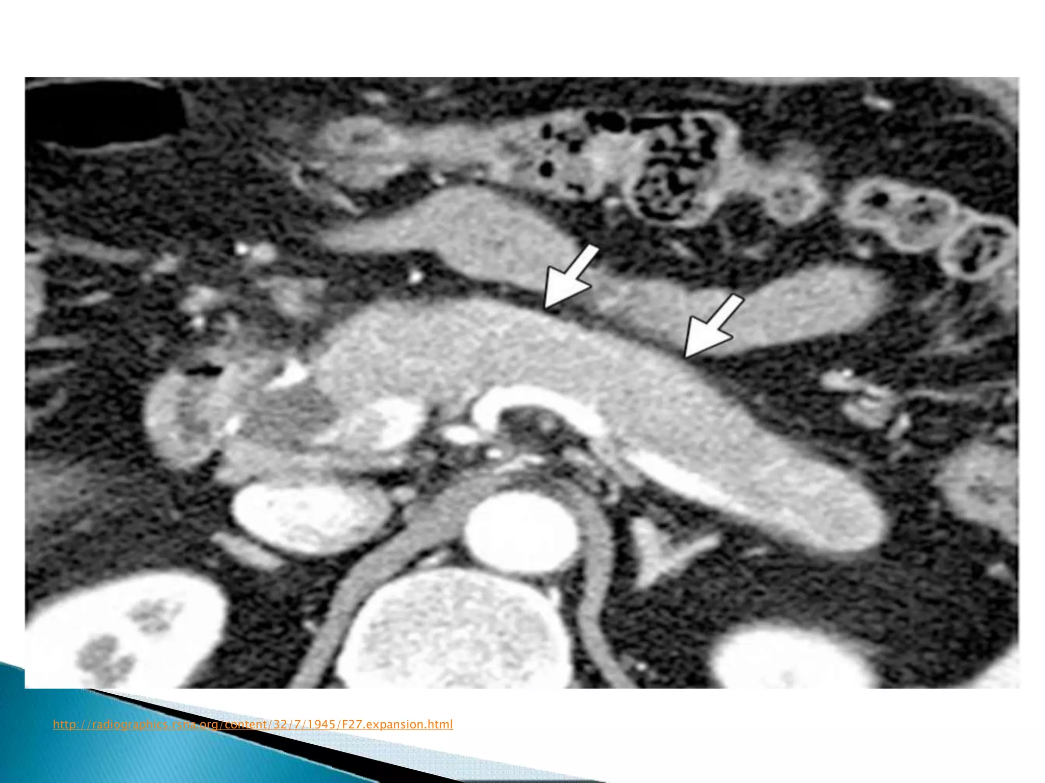 IgG4-Related Disease - Lam.pptx