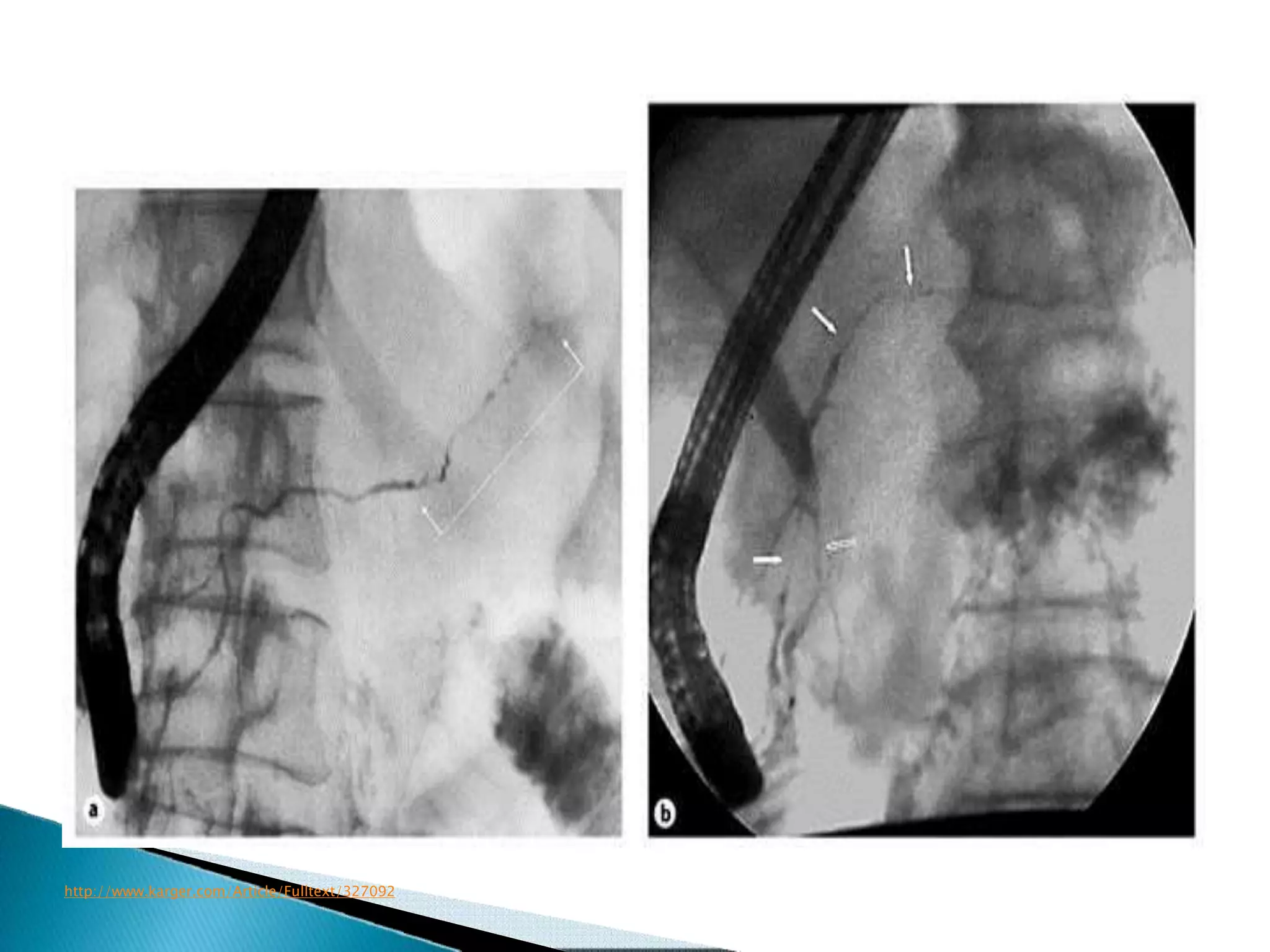 IgG4-Related Disease - Lam.pptx