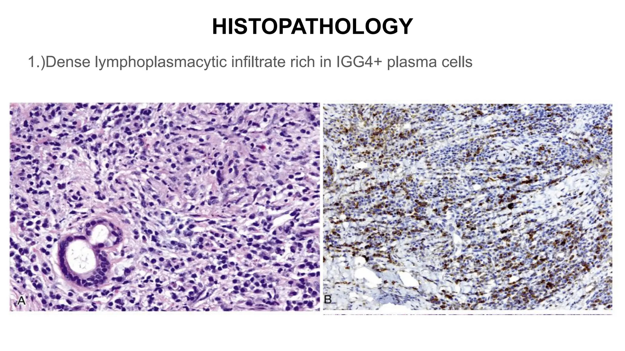 Igg4 related disease and it's management.pdf