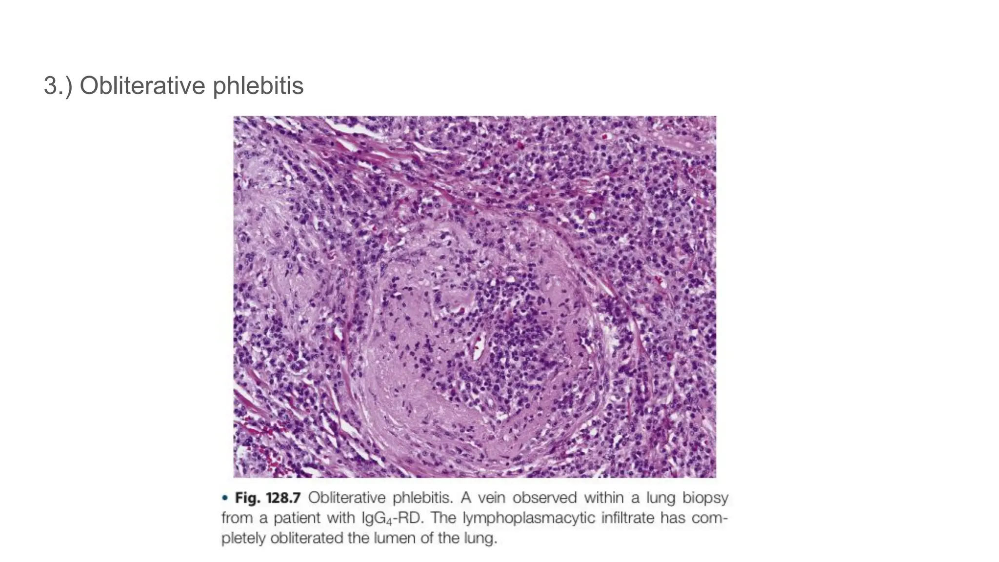 Igg4 related disease and it's management.pdf