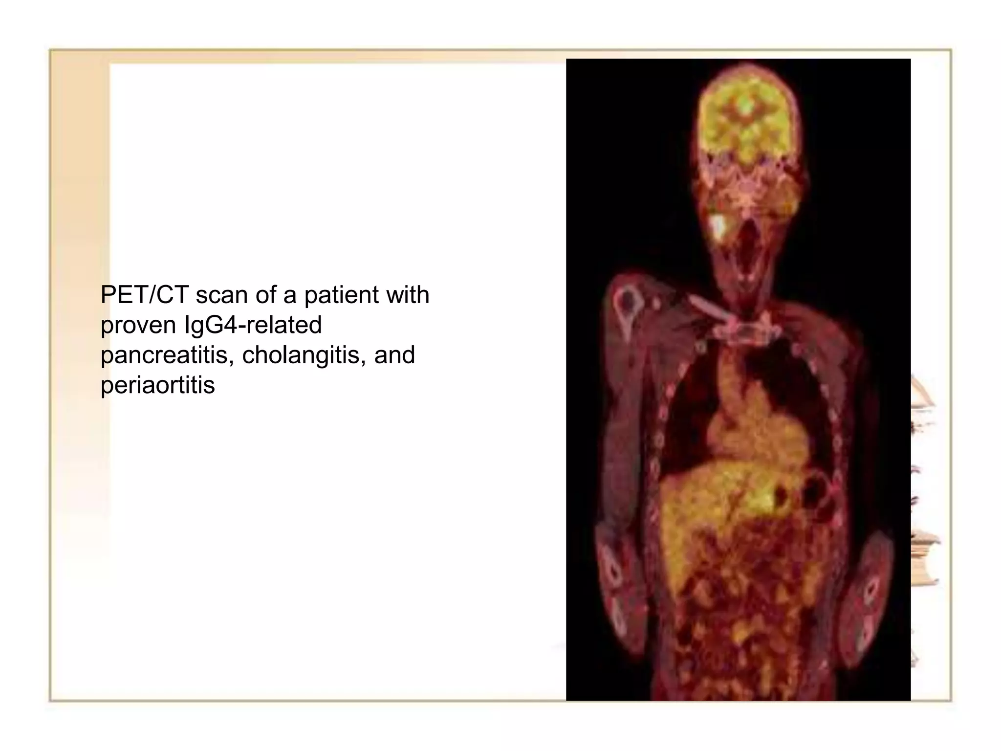 Ig g4 rd diagnosis and treatment | PPT