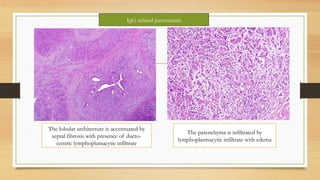IgG4 related diseases.................pptx