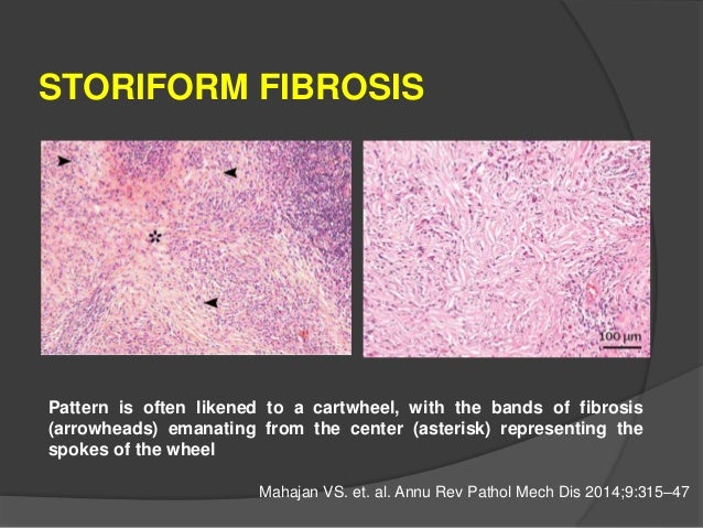 IgG4 related disorders afmc symposium arnab vardraj & mha khan