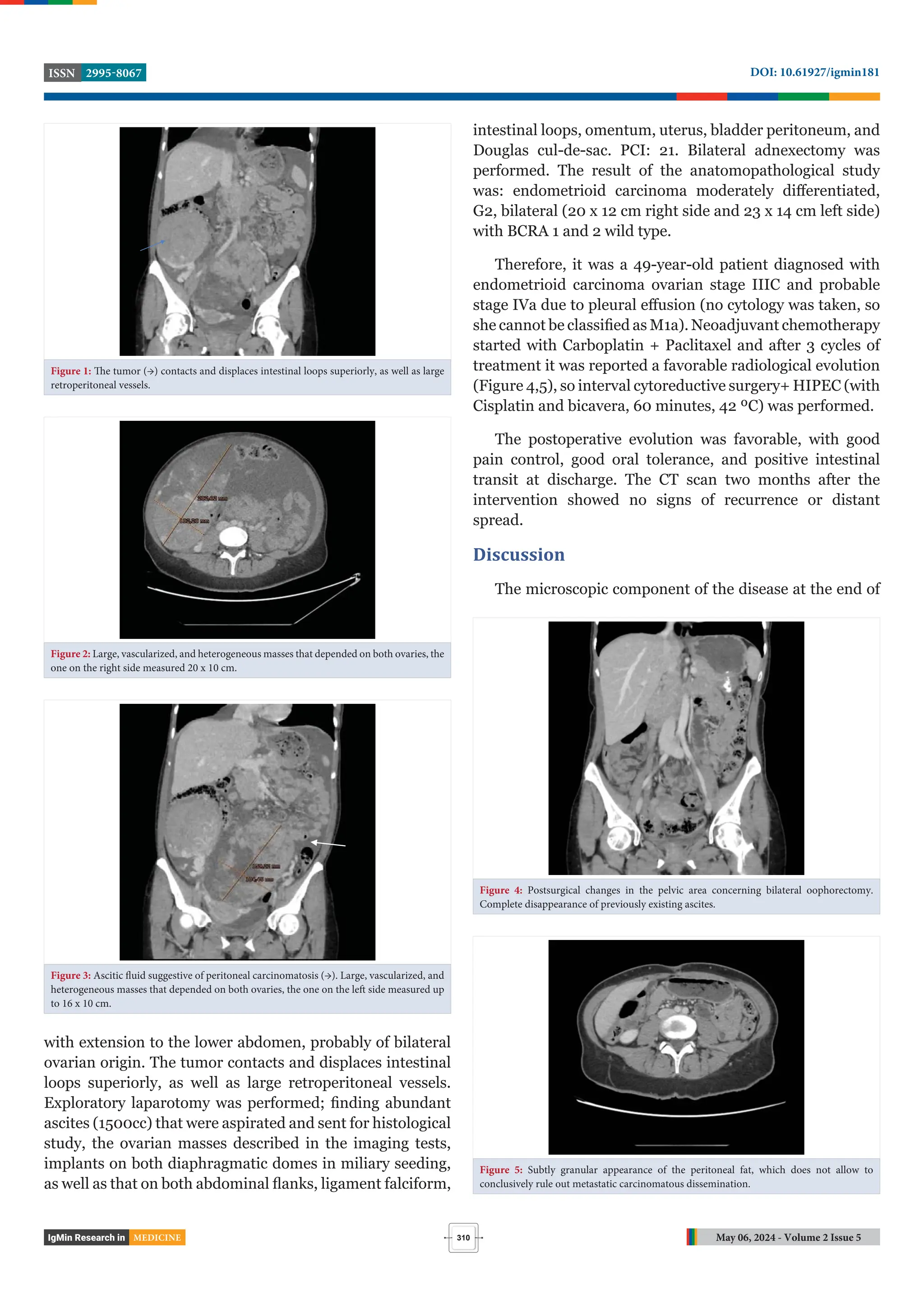 Fighting Peritoneal Carcinomatosis: A Case Study in Advanced Ovarian ...