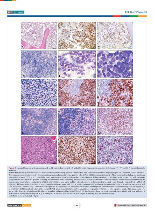 Unveiling Mastocytosis: Key Diagnostic Principles and Common Pitfalls | PDF