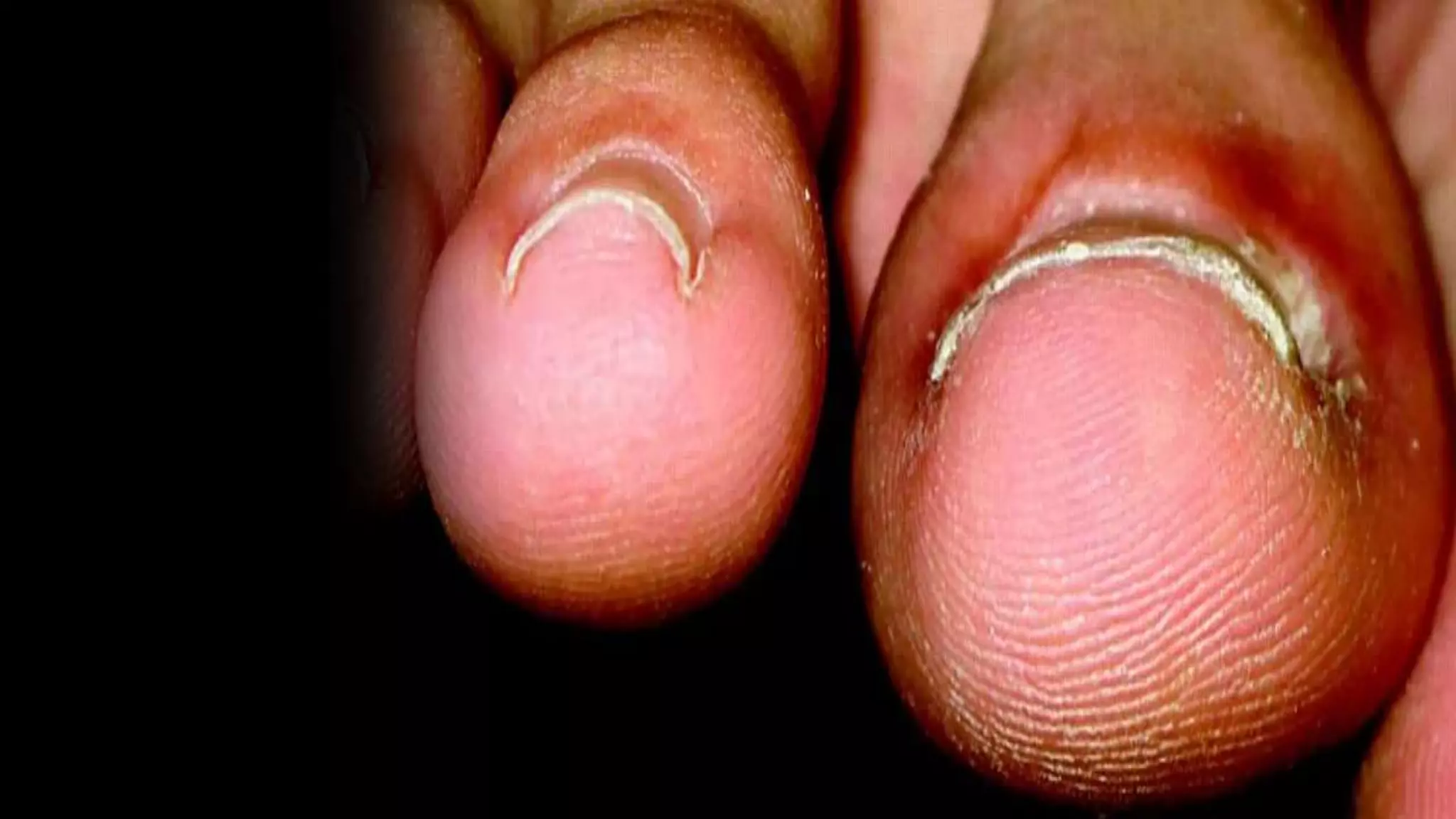 Ignoring An Ingrown Toenail? It's Time For Private Ingrown Toenail ...