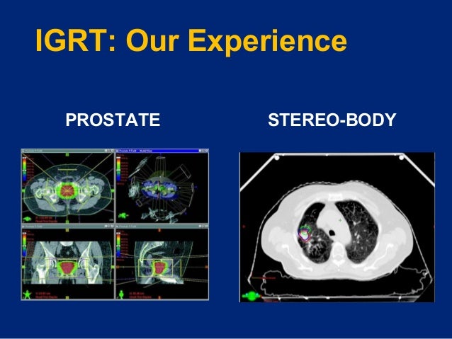 Image Guided Radiotherapy