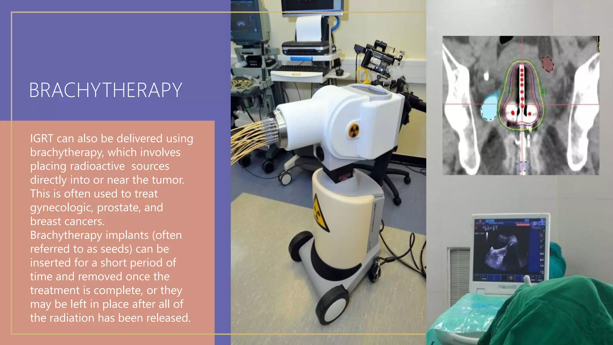 IGRT - Image Guided Radiotherapy Technique.pptx