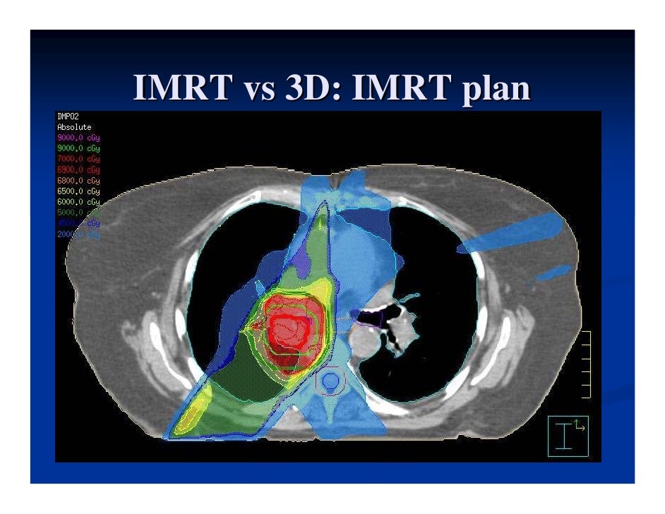 Igrt Srt For Lung Cancer