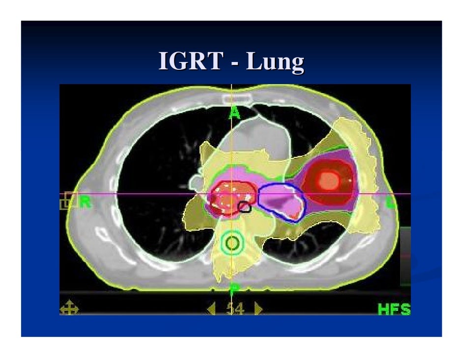 Igrt Srt For Lung Cancer