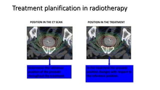 Image Guided Radiation Therapy (IGRT) | PDF