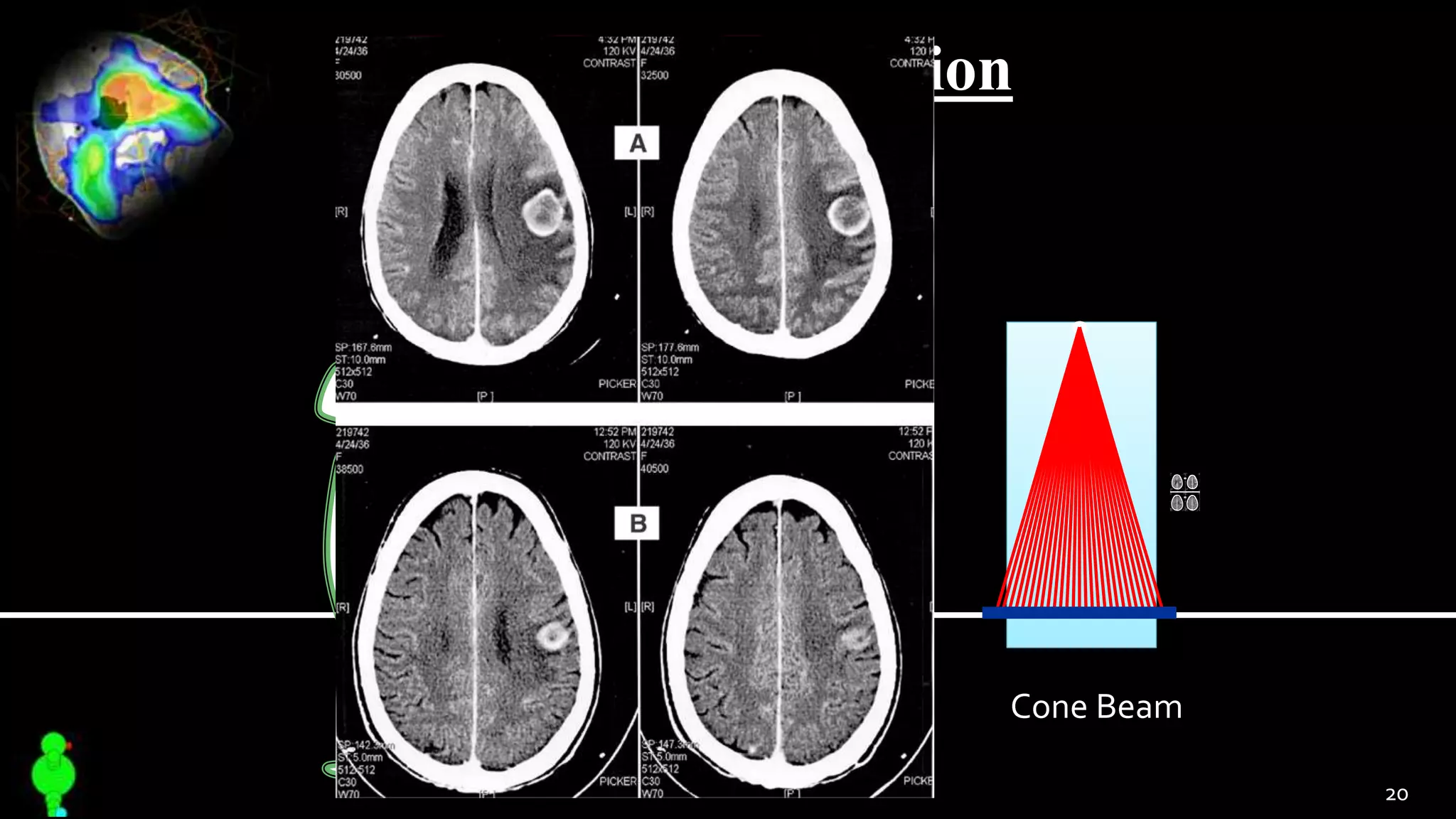 Image guided radiation therapy (IGRT) | PPTX