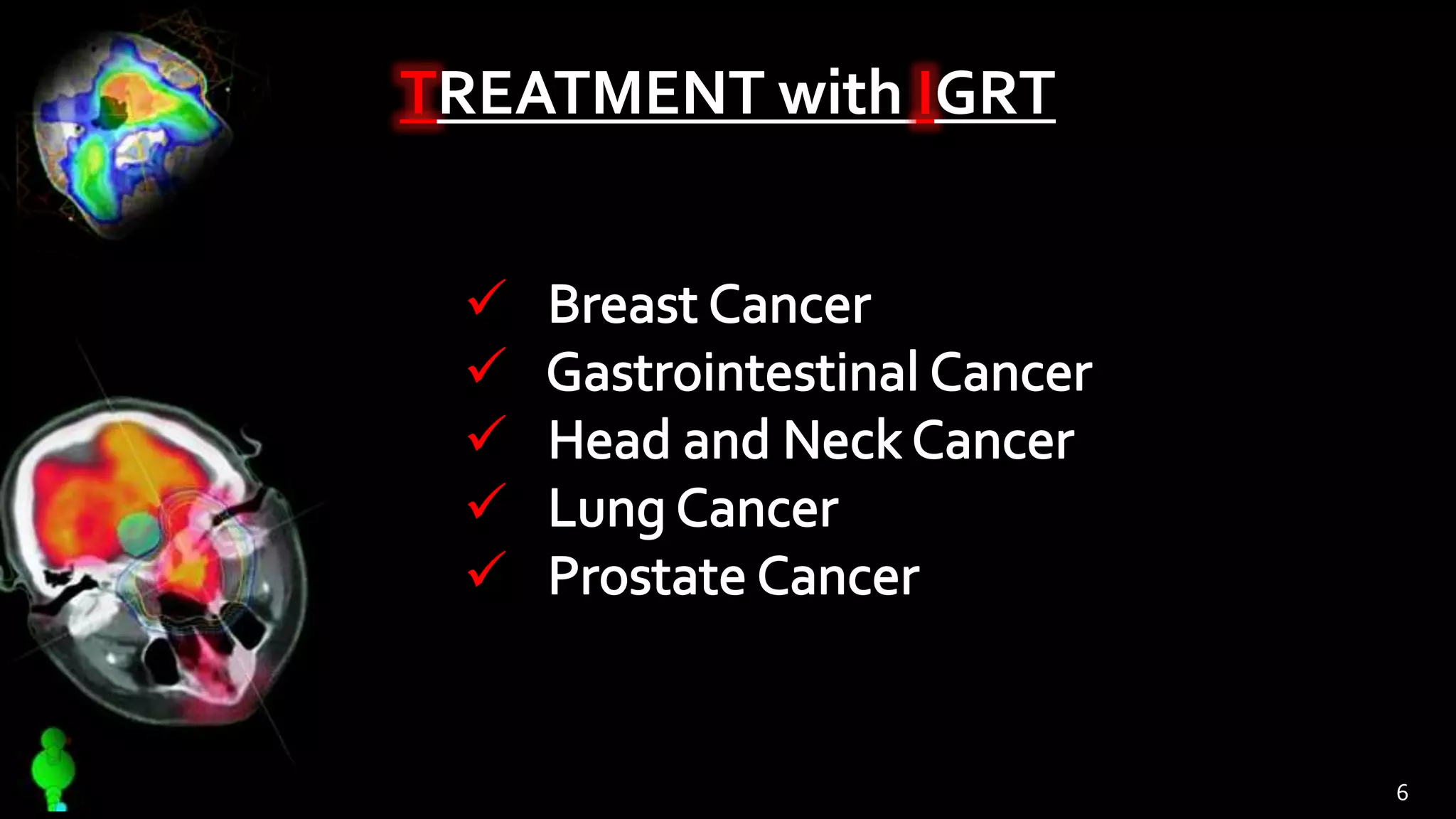 Image guided radiation therapy (IGRT) | PPTX