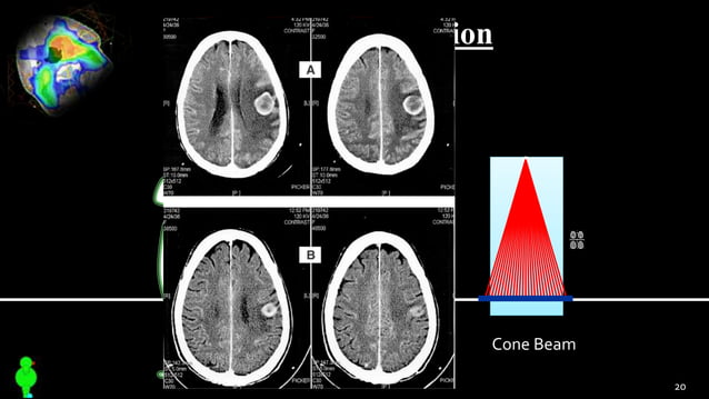 Image guided radiation therapy (IGRT) | PPTX | Physical Therapy | Wellness