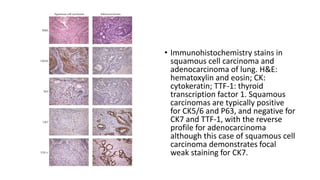 Immunohistochemistry in lung cancer | PPT