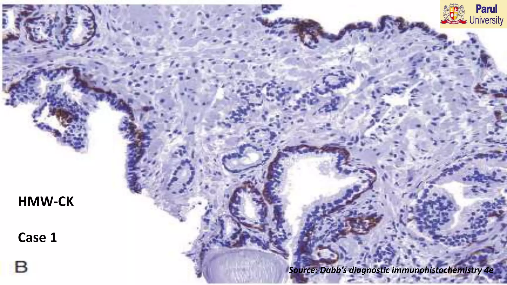 Immunohistochemistry of Prostatic lesions | PPTX | Cancer | Diseases ...