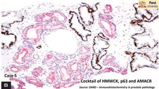 Immunohistochemistry of Prostatic lesions | PPTX