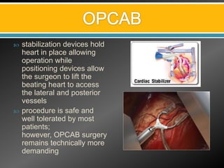 Ischemic Heart Disease Surgery | PPTX