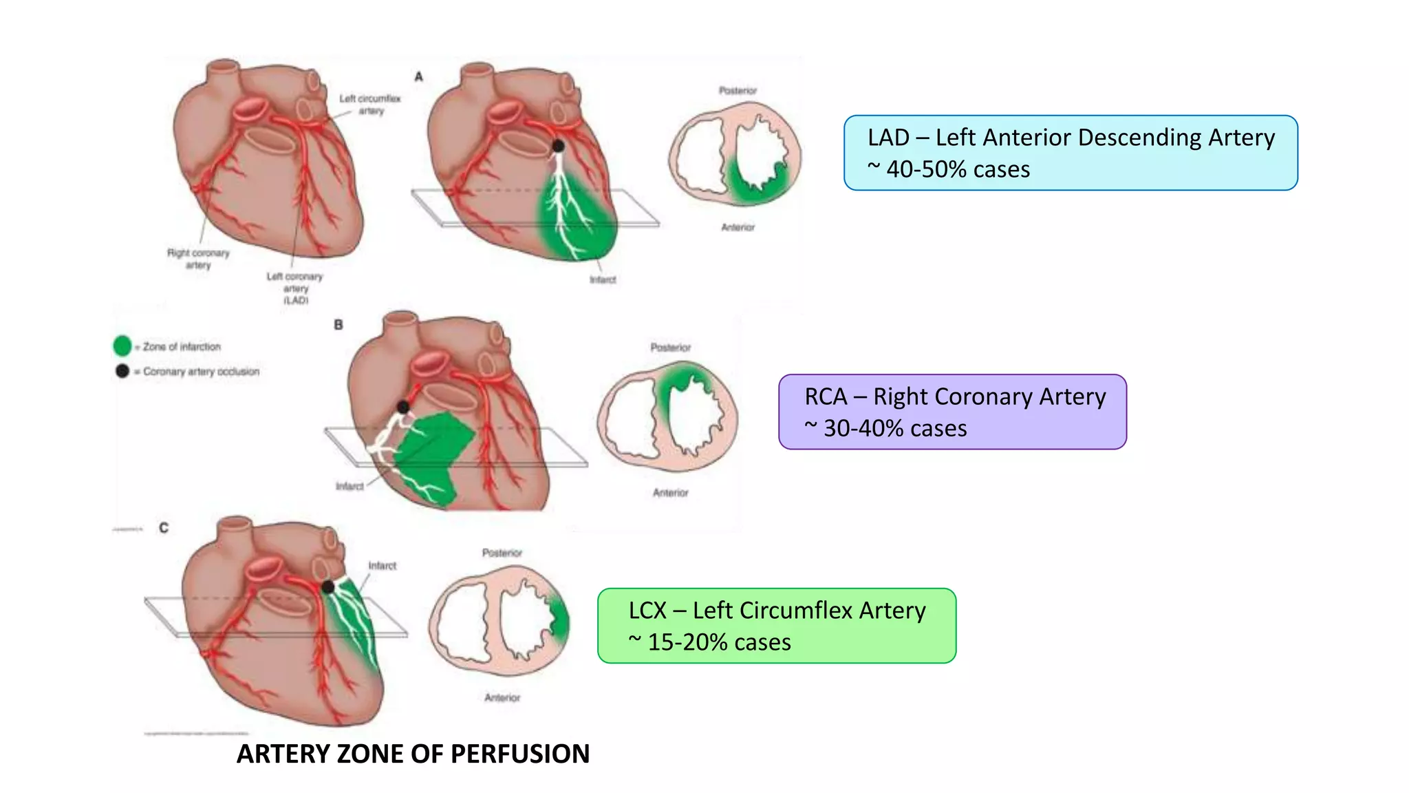 ISCHEMIC HEART DISEASE | PPTX