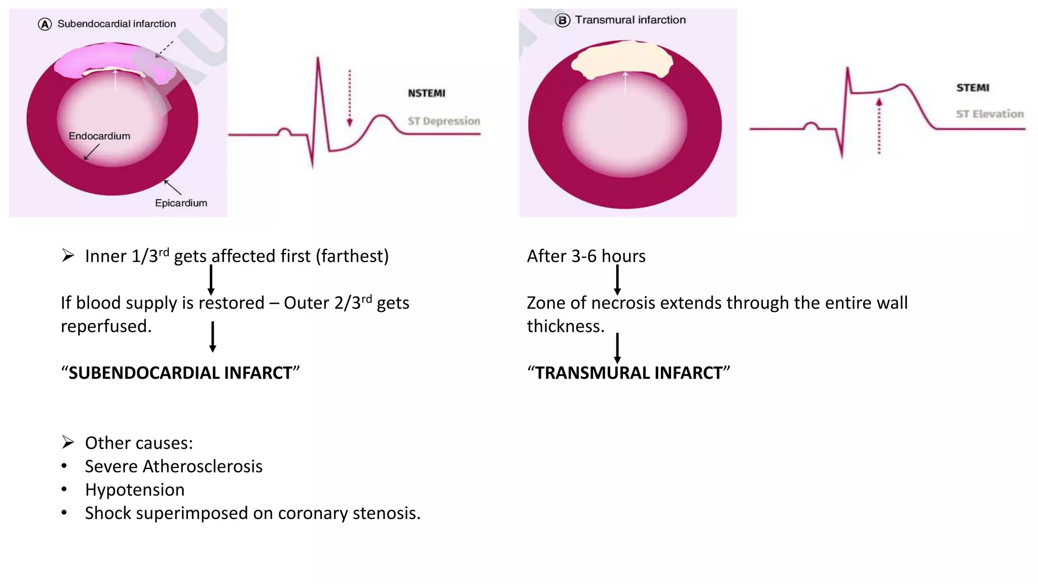ISCHEMIC HEART DISEASE | PPTX