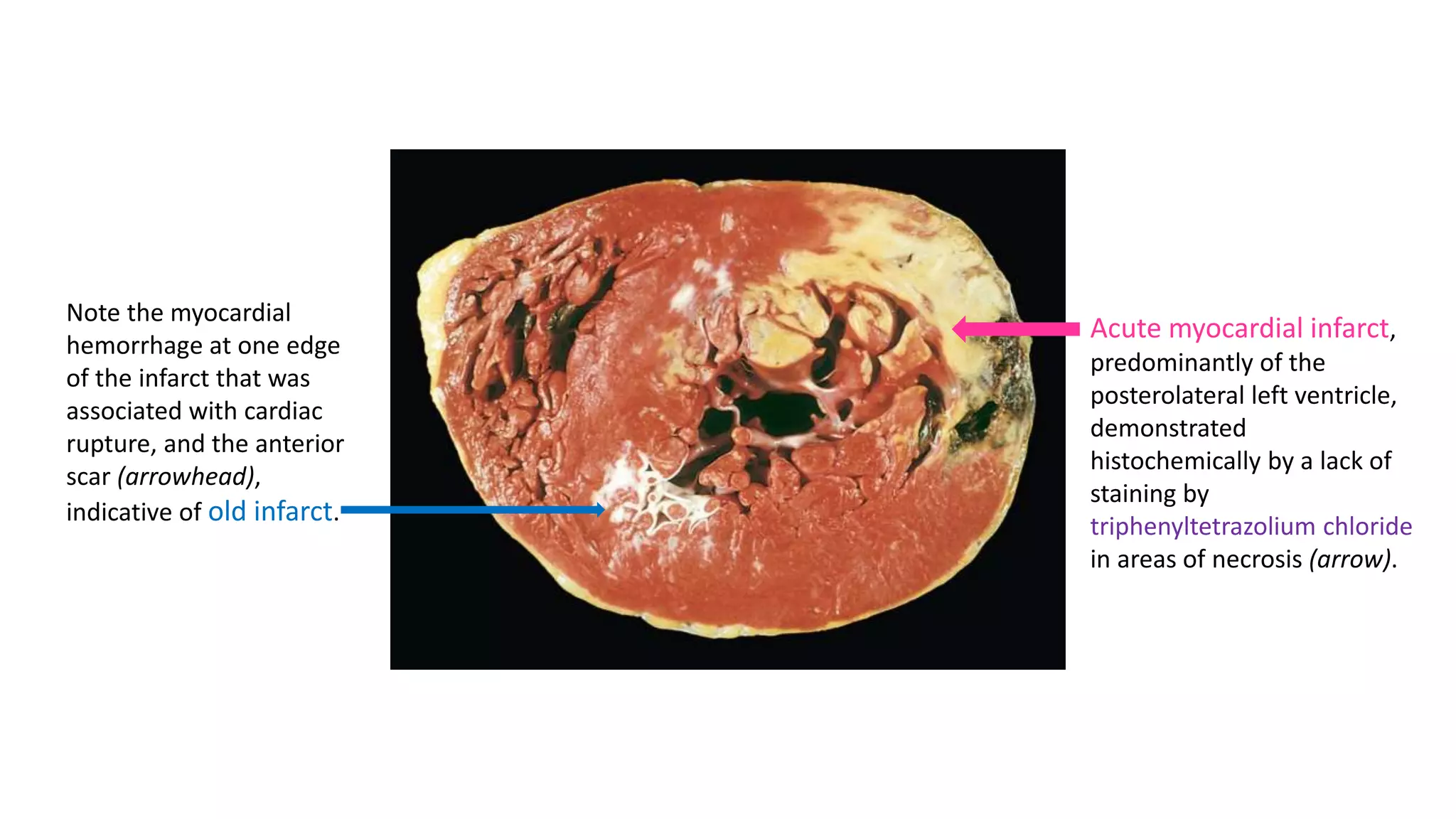 ISCHEMIC HEART DISEASE | PPTX
