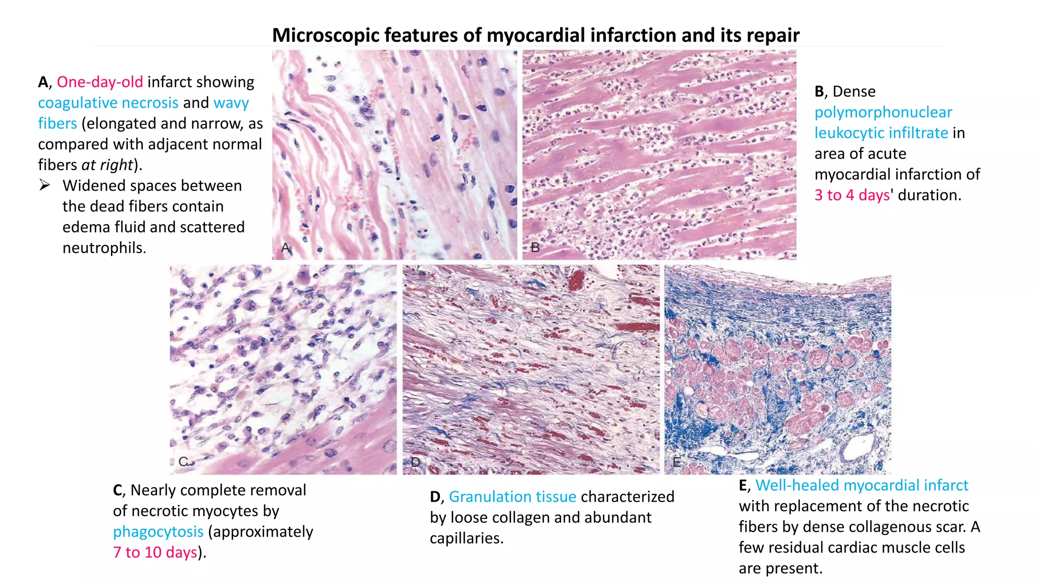 ISCHEMIC HEART DISEASE | PPTX
