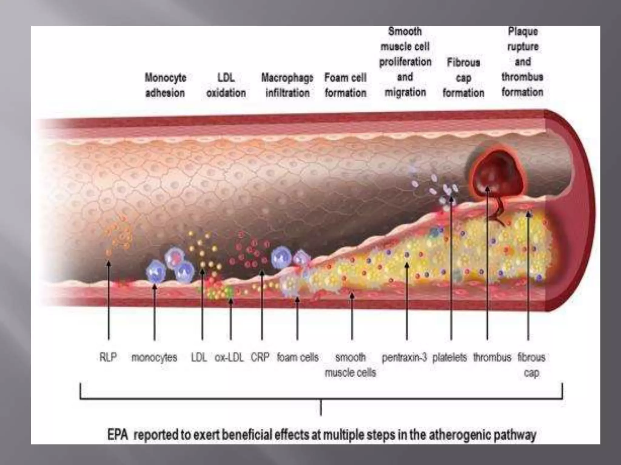 IHD.pptx | Heart and Cardiovascular Diseases | Diseases and Conditions