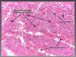 Sëmundjet Iskemike të Zemrës | PPT