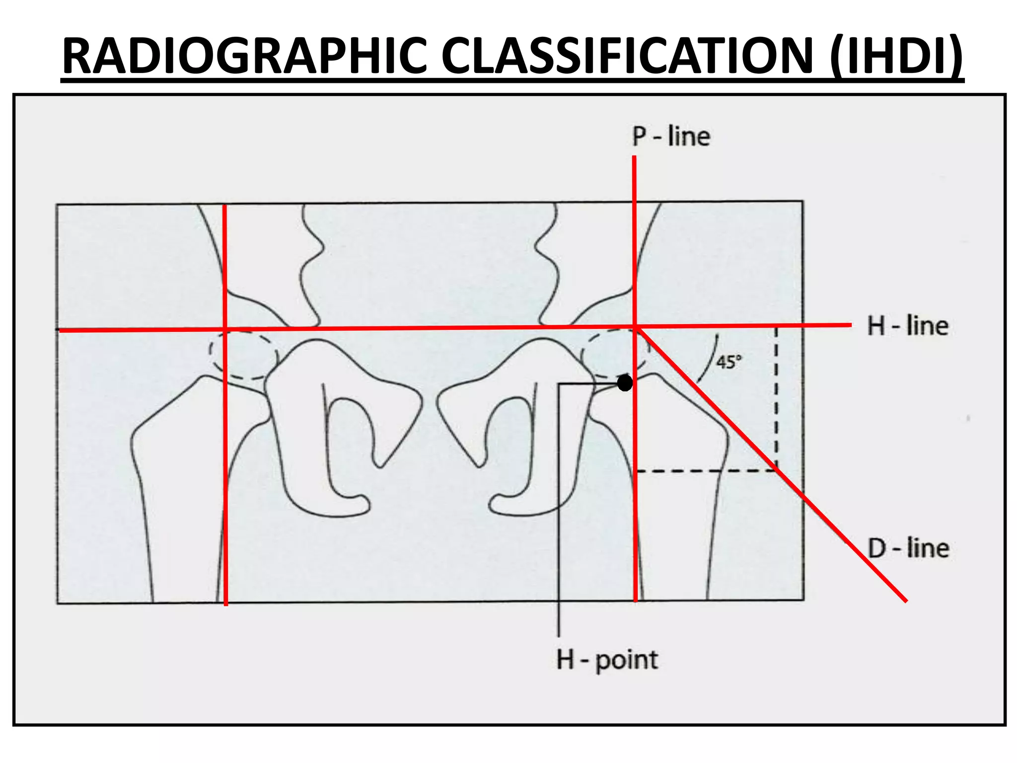 IHDI Classification of Hip Dysplasia | PPTX