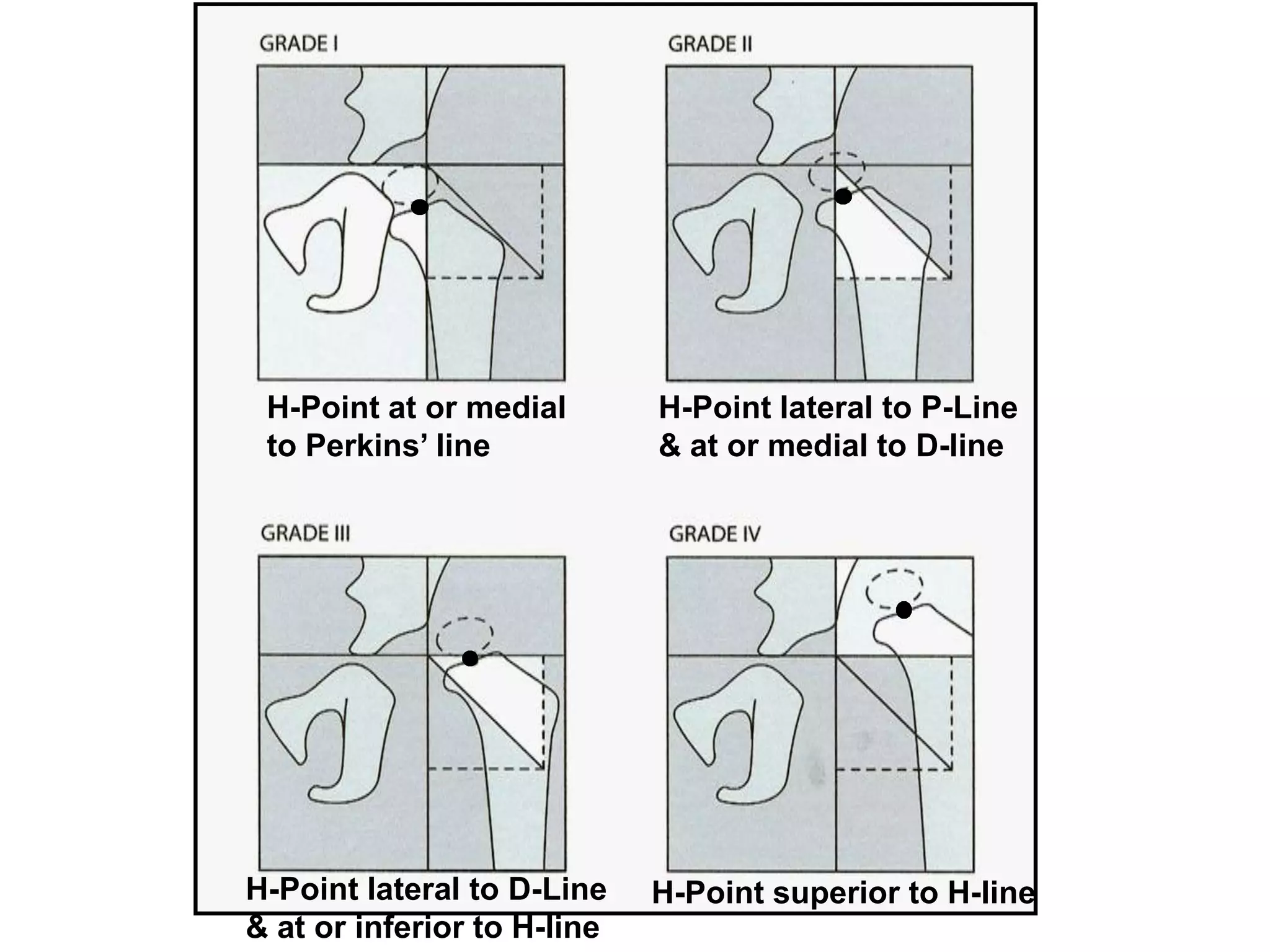 IHDI Classification of Hip Dysplasia | PPTX