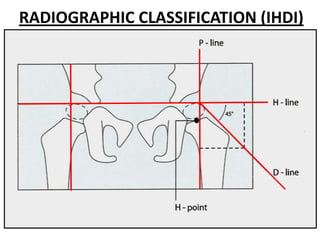 IHDI Classification of Hip Dysplasia | PPTX