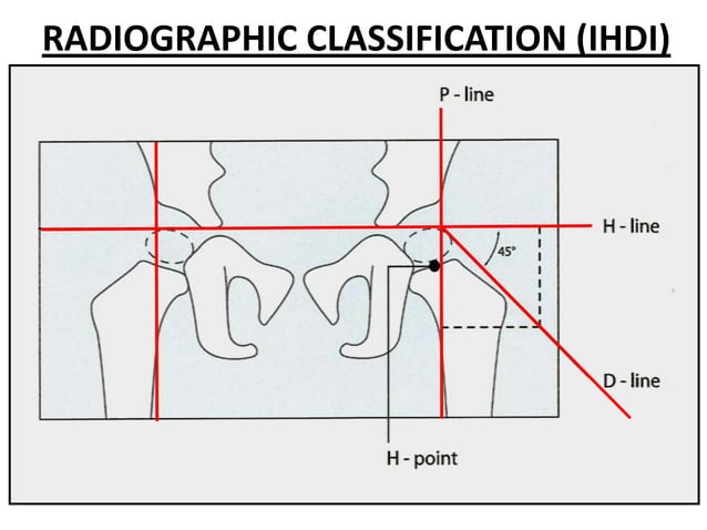 IHDI Classification of Hip Dysplasia | PPTX