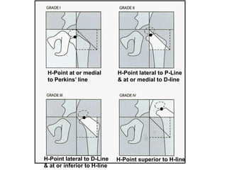 IHDI Classification of Hip Dysplasia | PPTX
