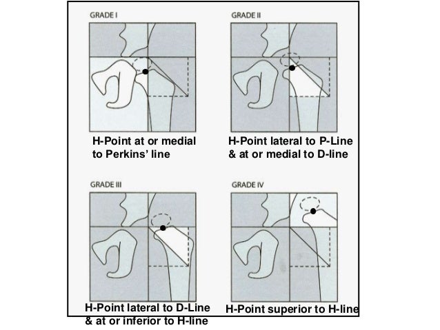 IHDI Classification of Hip Dysplasia